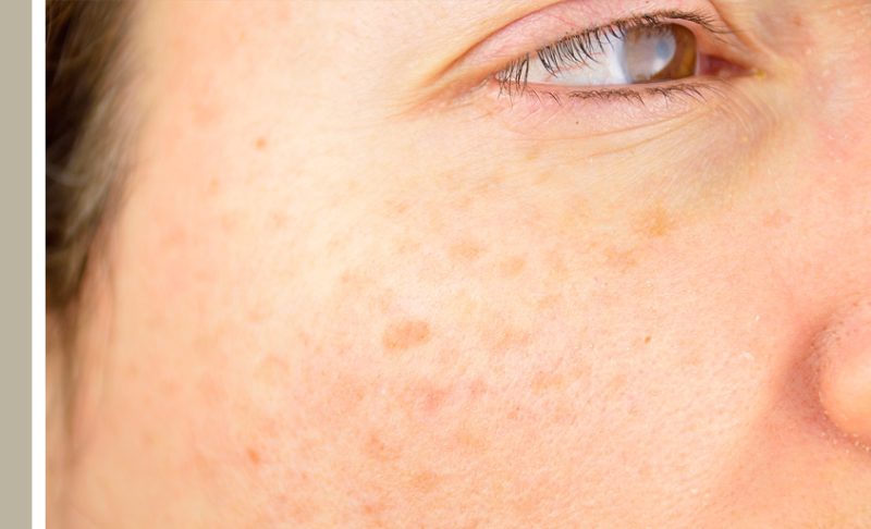 Protege tu piel del sol este verano: Consejos para prevenir las manchas ...